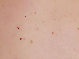 ¿Qué son esos puntos rojos que se forman en nuestro cuerpo ...